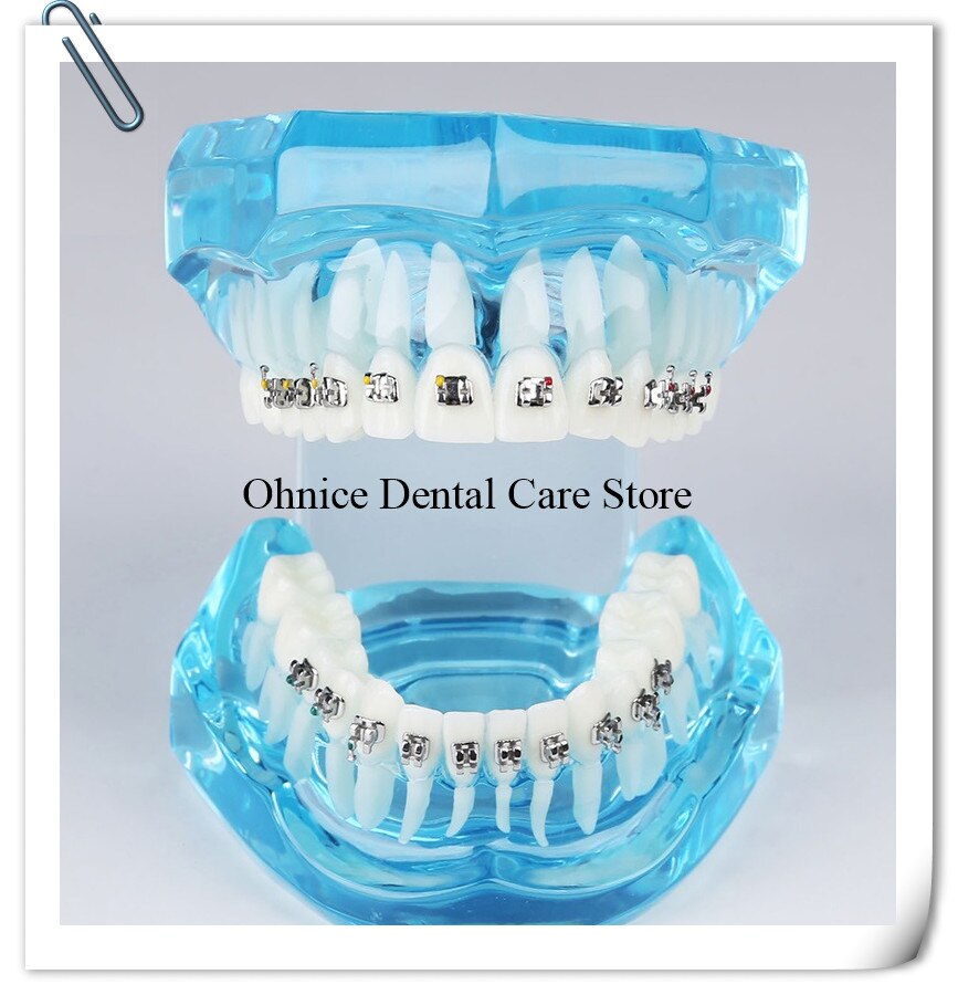 Dental orthodontic teeth model withbrackets buccal... – Vicedeal
