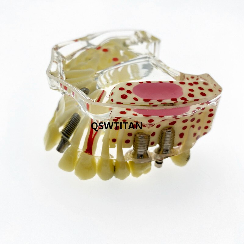 Dental Implant Upper Jaw Model With Bridge & C... – Grandado