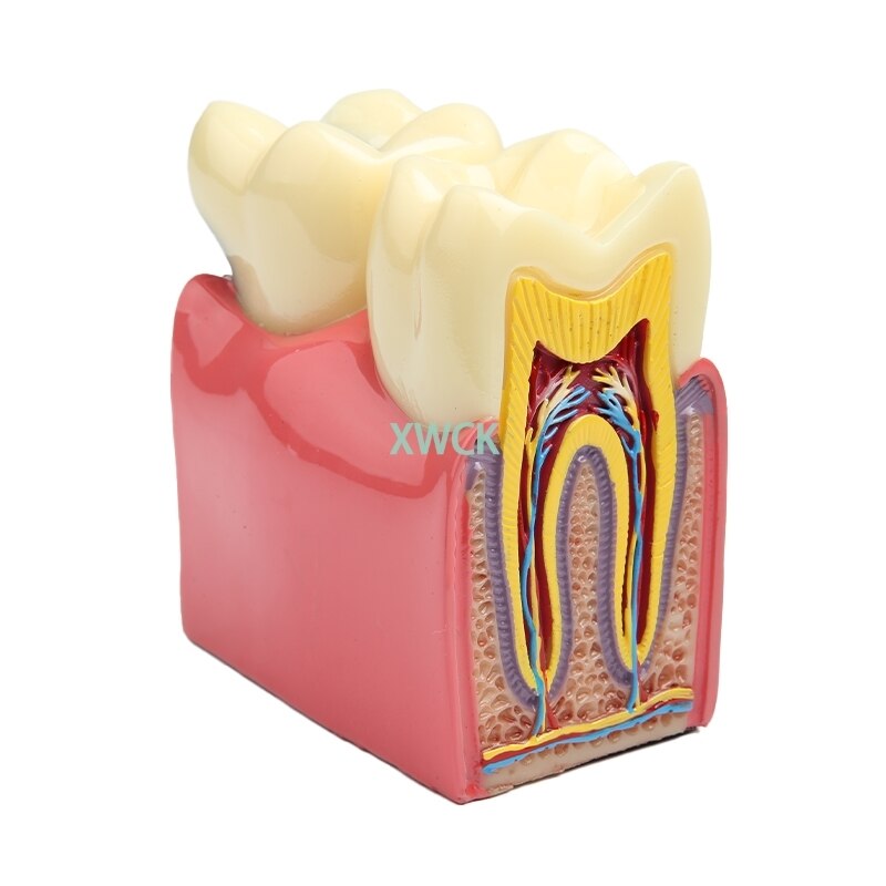 1Pcs 6 Times Dental Caries Comparsion Models Tooth... – Vicedeal
