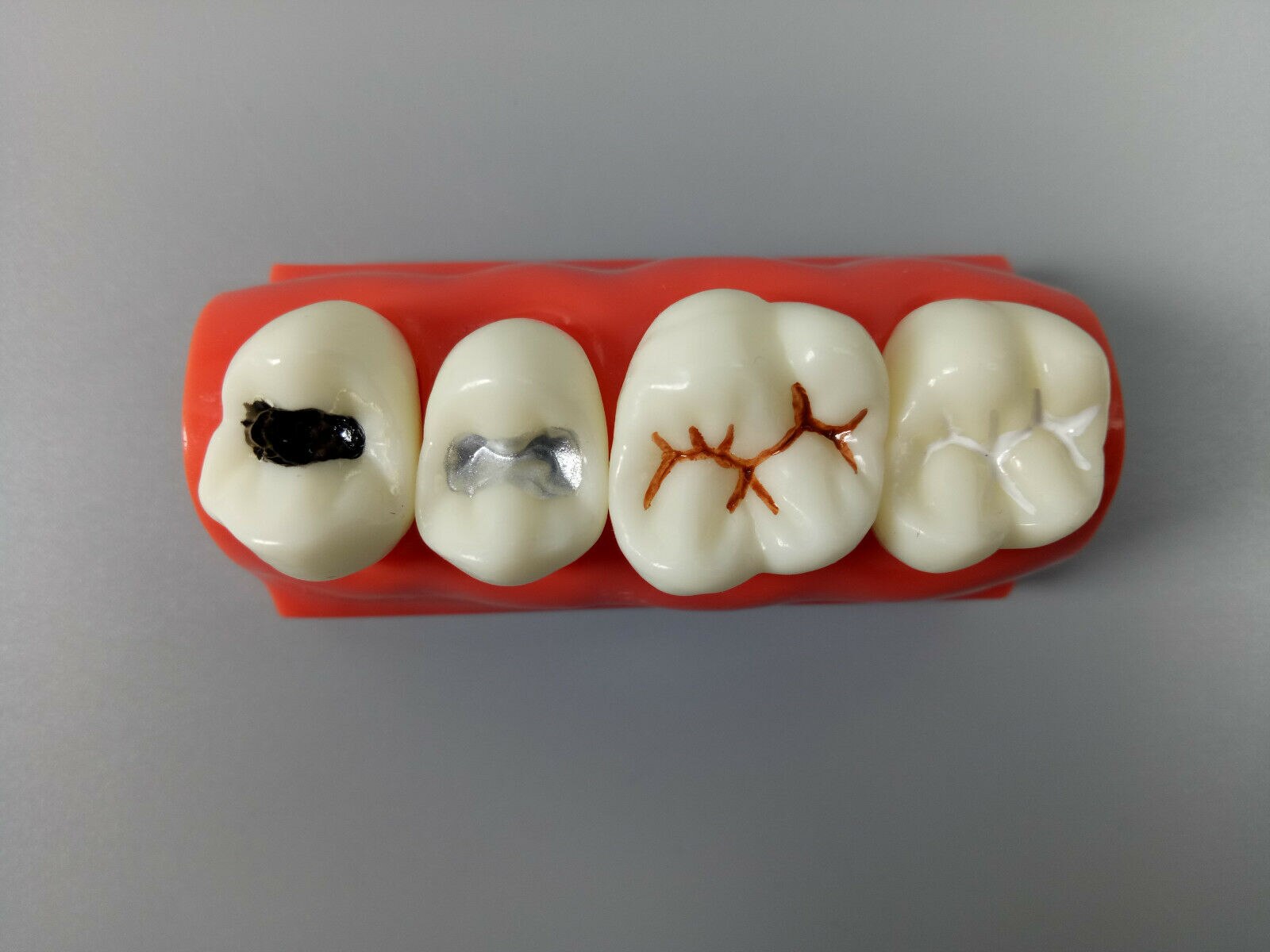 1Piece Dental Adhesive Pit Fissure Sealant Study M... – Grandado
