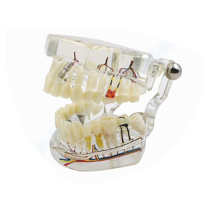 dental teeth model Transparent pathological implan... – Vicedeal