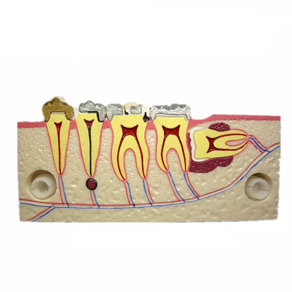 Right Lower Tooth Decomposition Model Molar Cross ... – Grandado