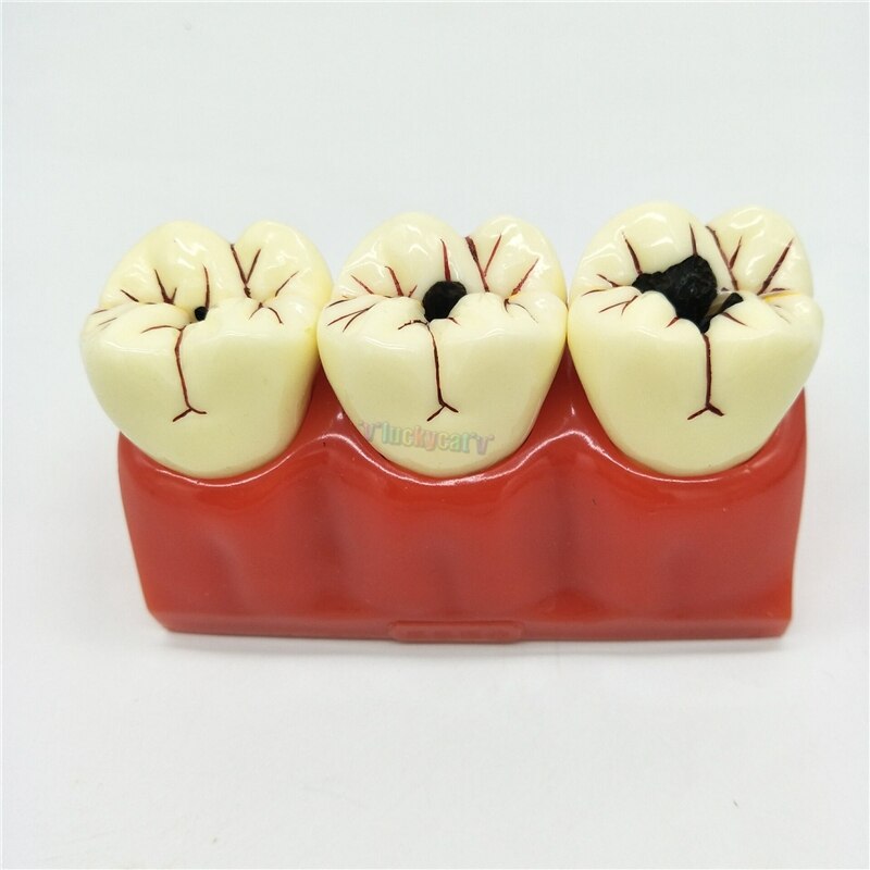 4 times Dental Caries Decomposition Model Oral tea... – Vicedeal