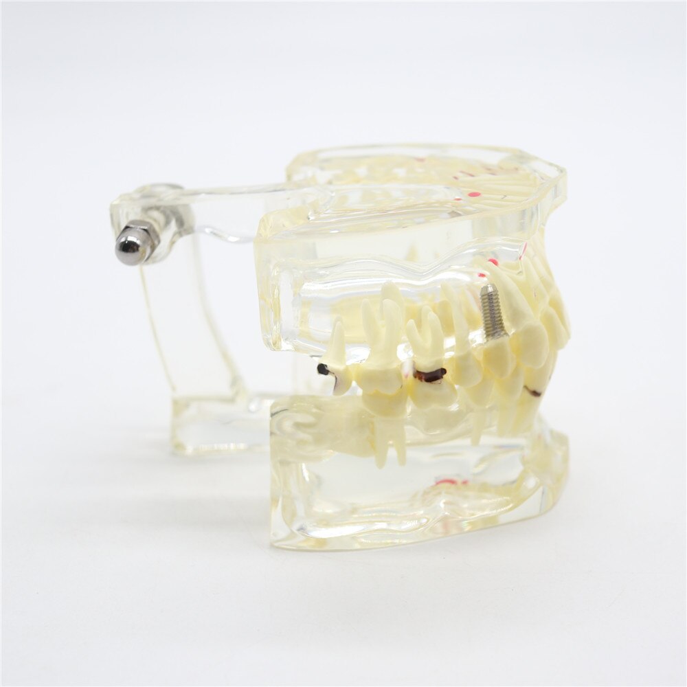 Dental Supplies Implant Disease Tooth Pathological... – Vicedeal