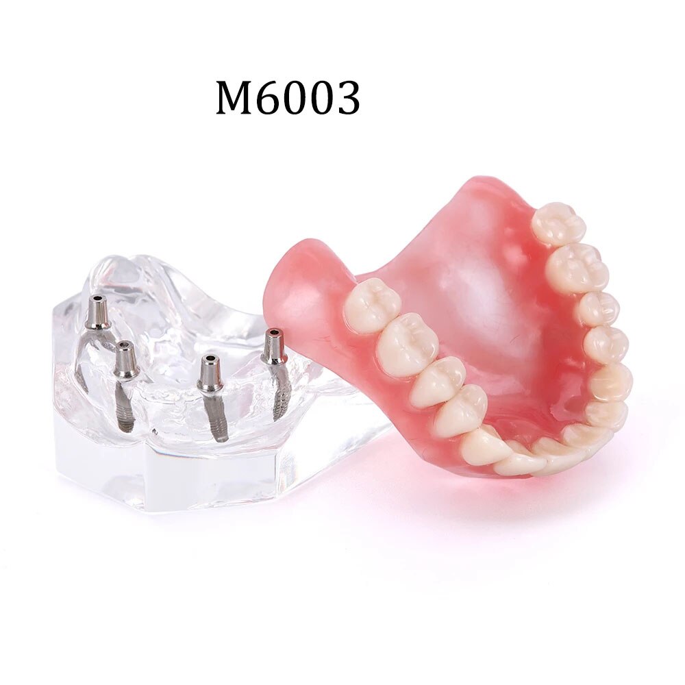 Dental Implant Restoration Teeth Model Demo Overde... – Vicedeal
