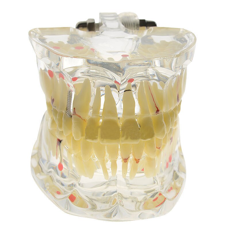 Implant Disease Teeth Model with Restoration Bridg... – Vicedeal