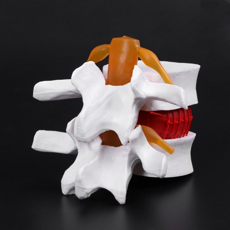 Human Anatomical Lumbar Disc Herniation Model Lear... – Grandado