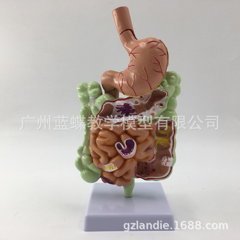 Pathological model of large intestine stomach mode... – Vicedeal