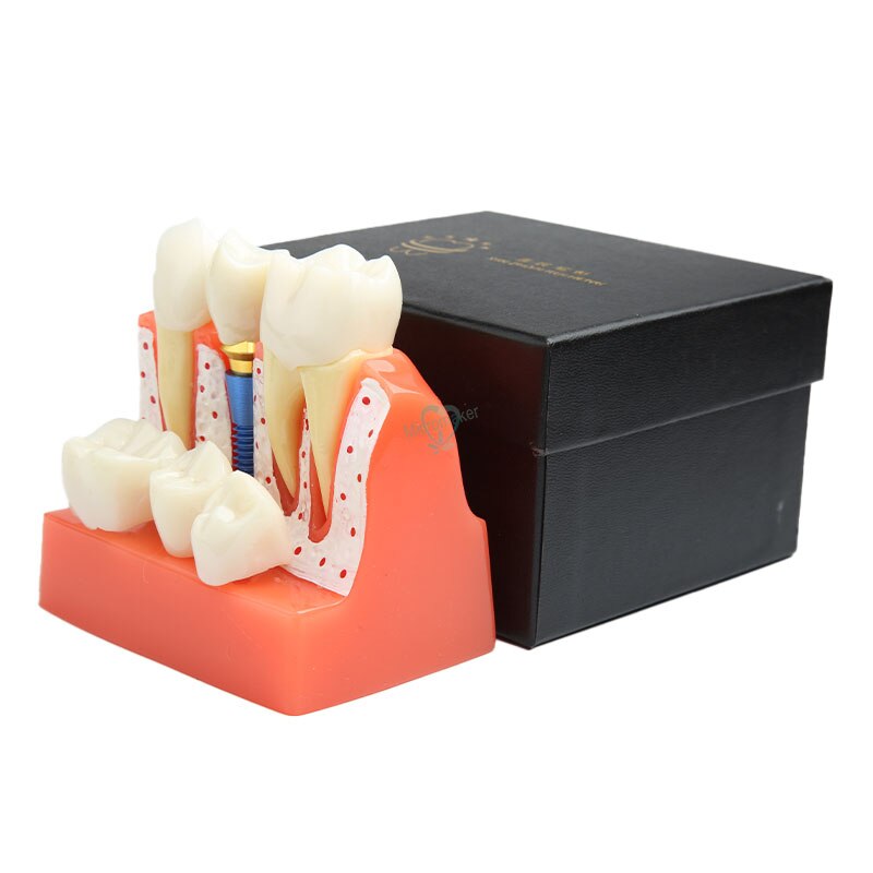 1pcs Dental Demonstration Teeth Model Dental Teach... – Vicedeal
