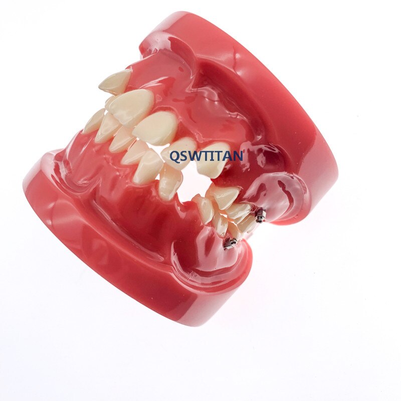 Dentist Orthodontic Tooth Model Demonstration Teac... – Vicedeal
