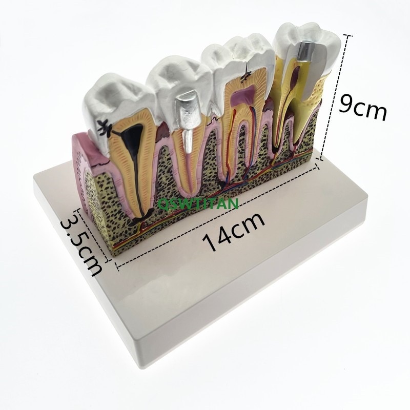Dental Caries Comparation Anatomy Teeth Model for ... – Vicedeal
