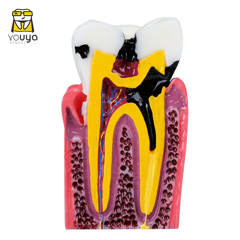 6 Times Dental Model Molar Pathological Anatomic C... – Vicedeal
