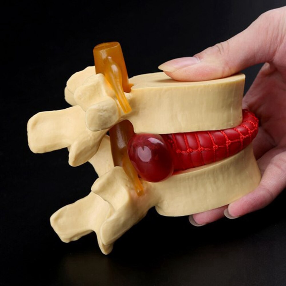 Lumbar Vertebrae Model Anatomical Spine Lumbar Dis... – Grandado