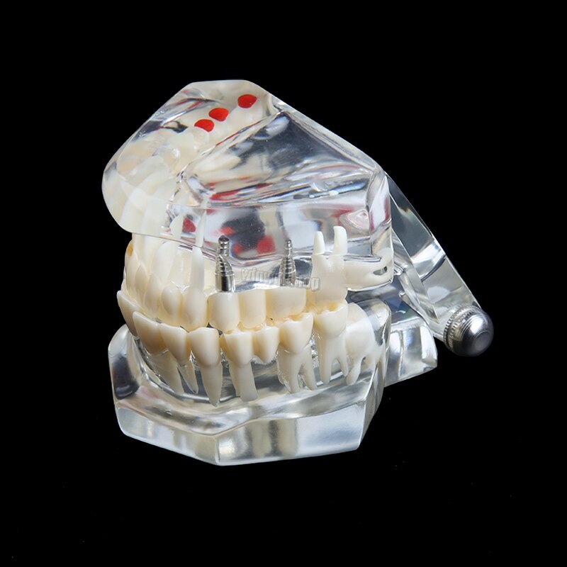 Dentist tooth human anatomy model classic repairab... – Grandado