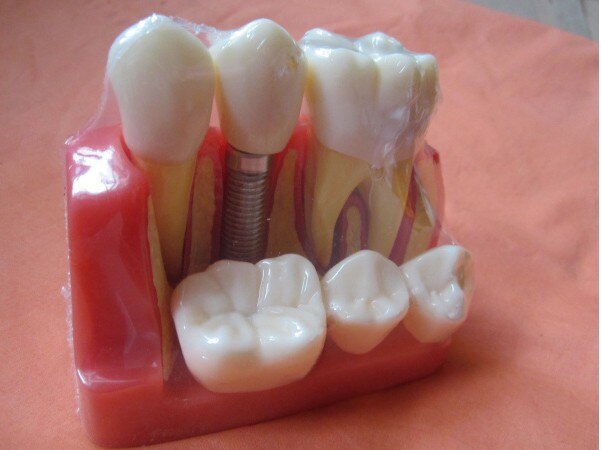Dental teeth model dental planting teeth model dec... – Grandado