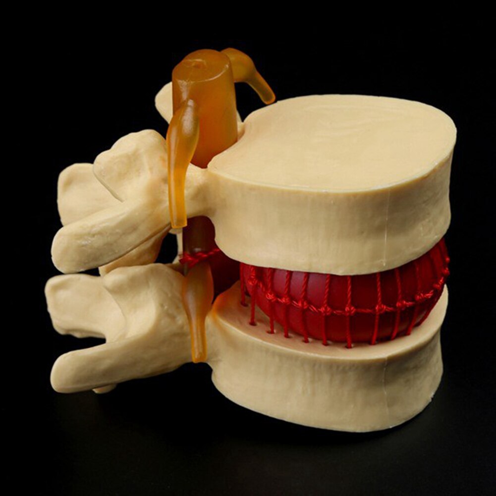 Lumbar Vertebrae Model Anatomical Spine Lumbar Dis... – Vicedeal