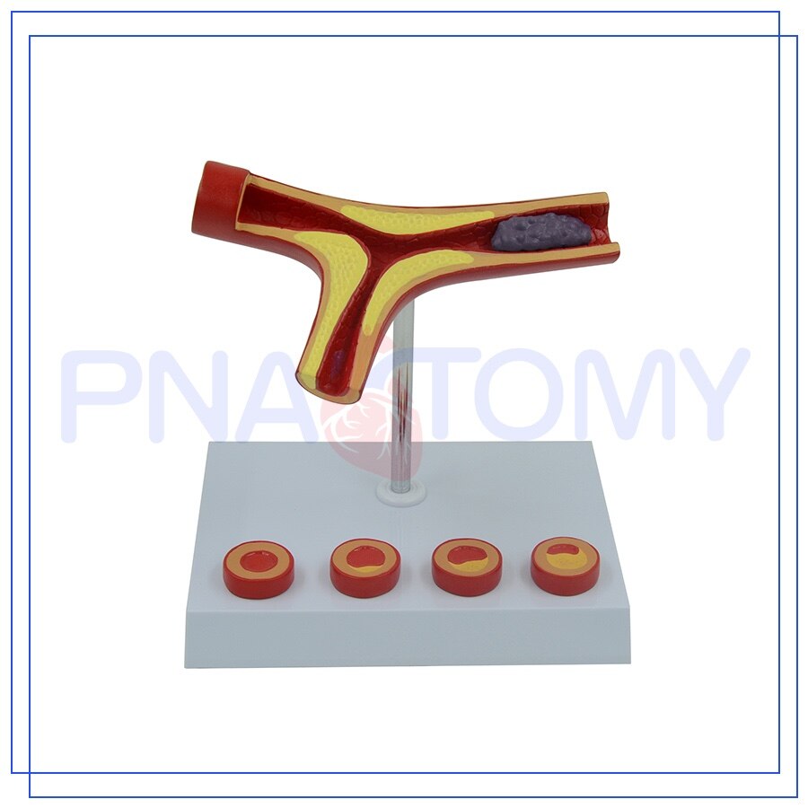Arteriosclerose Model Met Trombus Voor Menselijk S... – Vicedeal