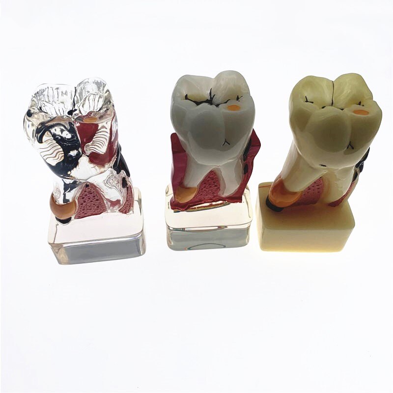 Teeth Model 4 times tooth pathology model Comprehe... – Grandado