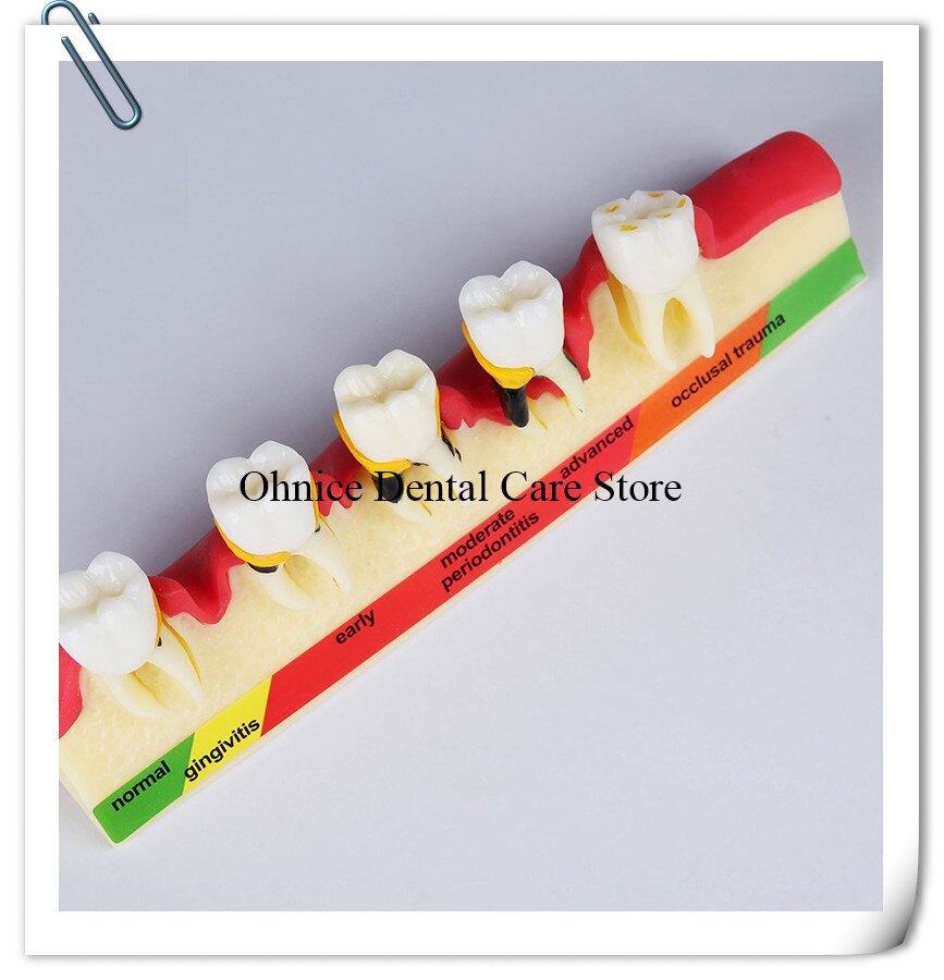 Dental Pathology teaching Model shows progress of ... – Vicedeal