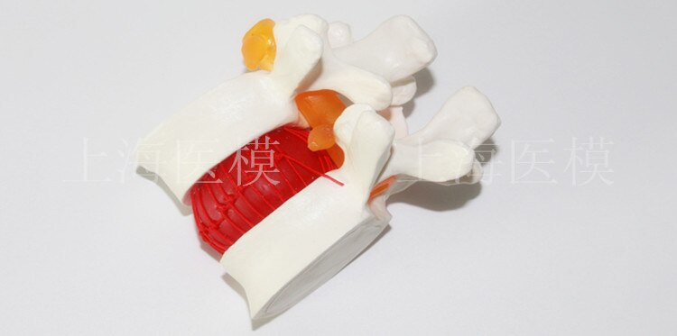 Human lumbar disc herniation model demonstration m... – Grandado