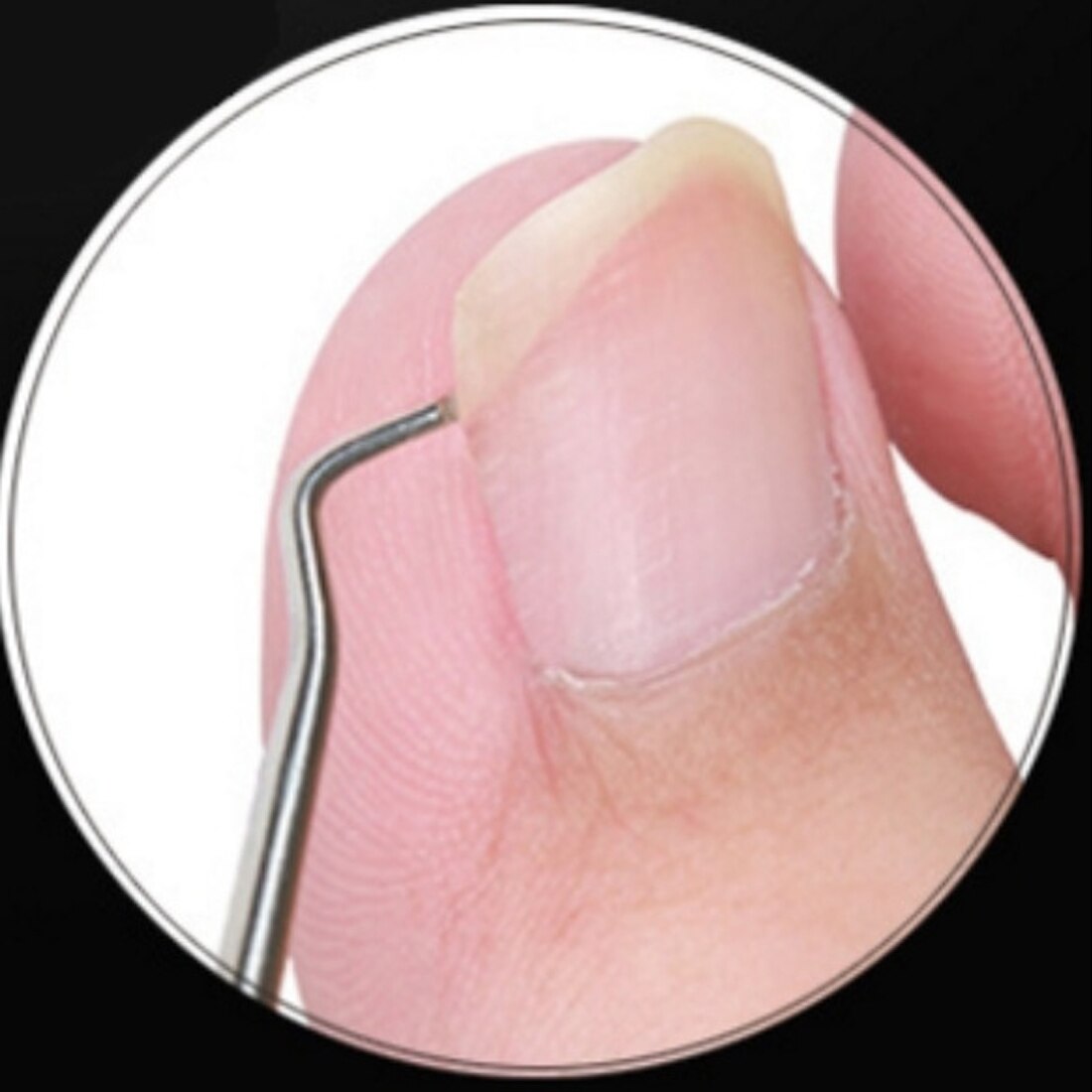 Clean Installation Tool Double Ended Ingrown Toe N... – Vicedeal