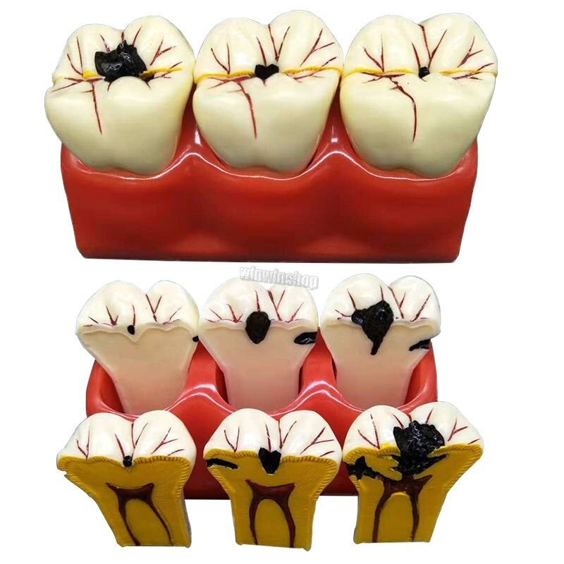 Dental Caries Decomposition Model Oral teaching Mo... – Grandado