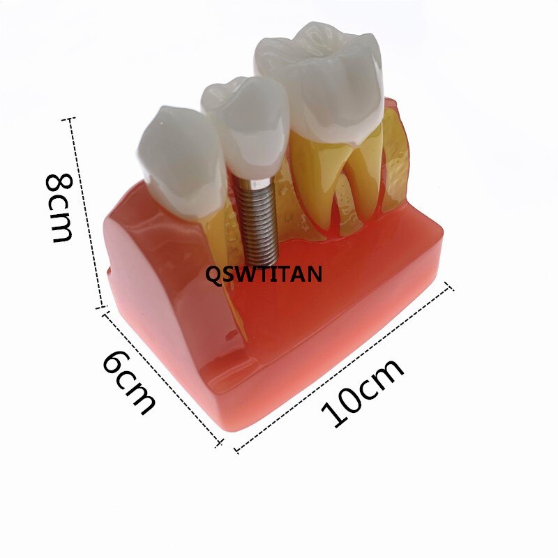 Dental 4 times planting Teeth model Analysis Crown... – Vicedeal