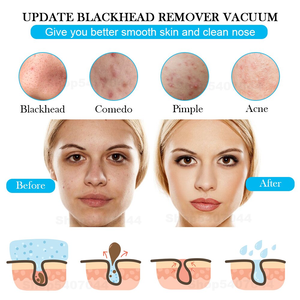 Hydrogen Oxygen Small Bubble Blackhead Remover LED... – Vicedeal