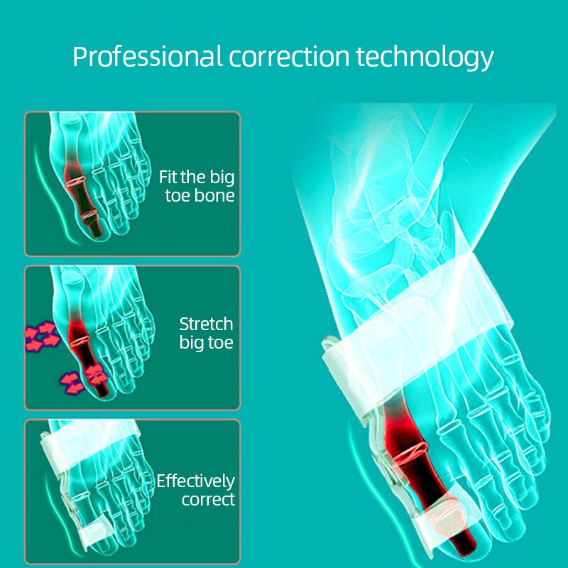 Big Toe Corrector Hallux Valgus Bunion Splint Corr... – Grandado