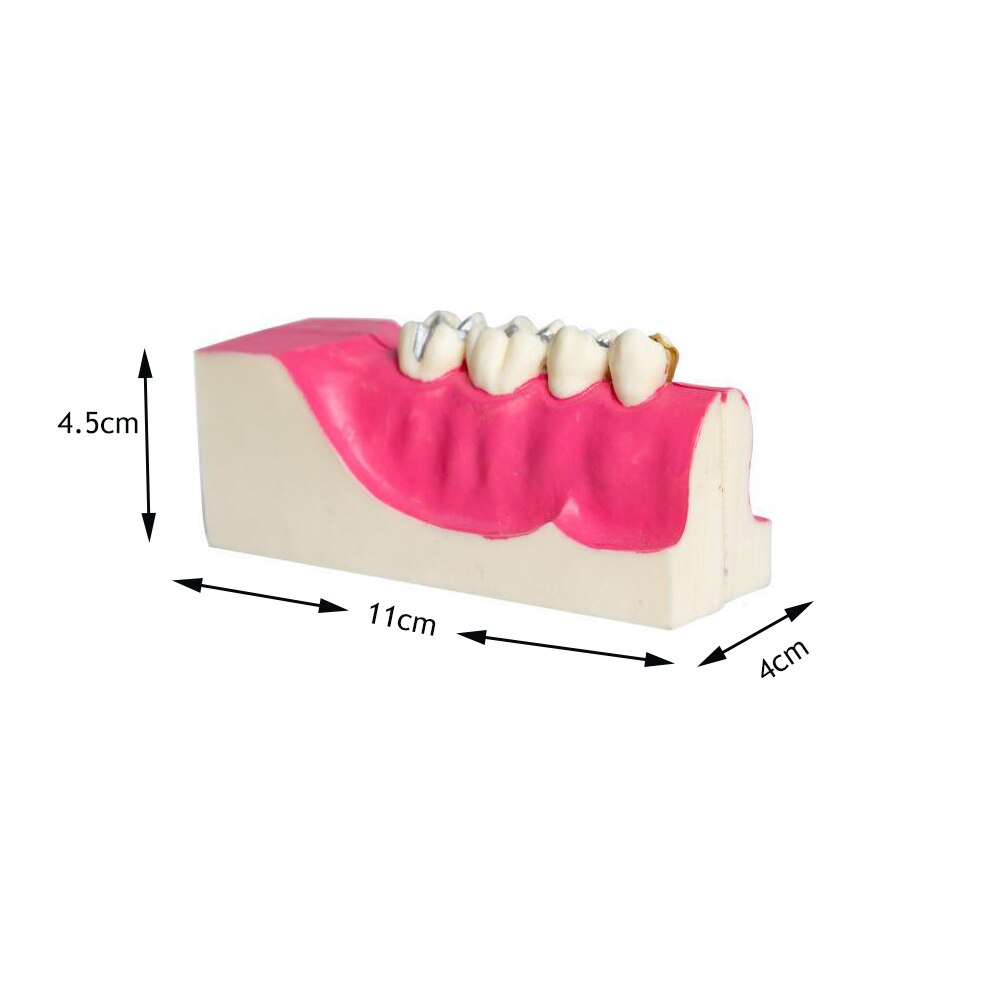 Right Lower Tooth Decomposition Model Molar Cross ... – Grandado