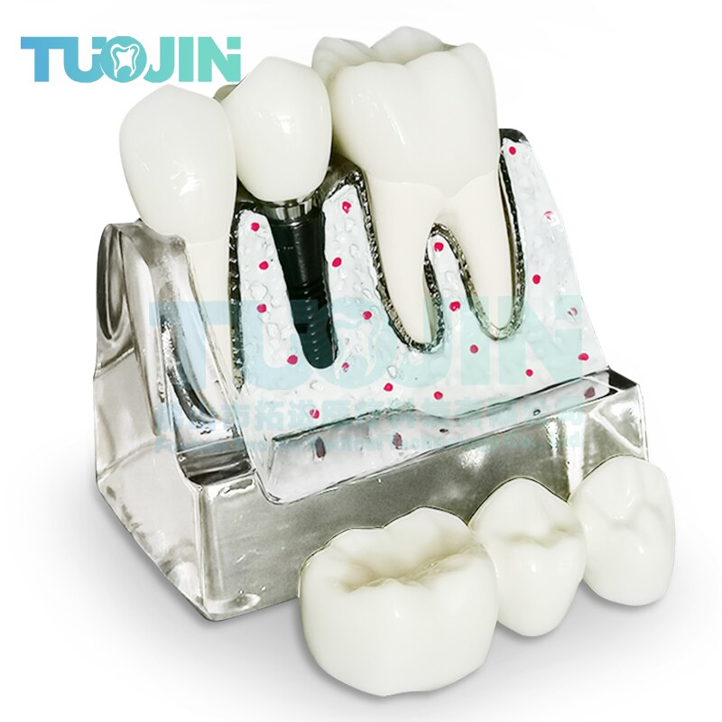 Dental Implant Model 4 Times Analysis Crown Bridge... – Vicedeal