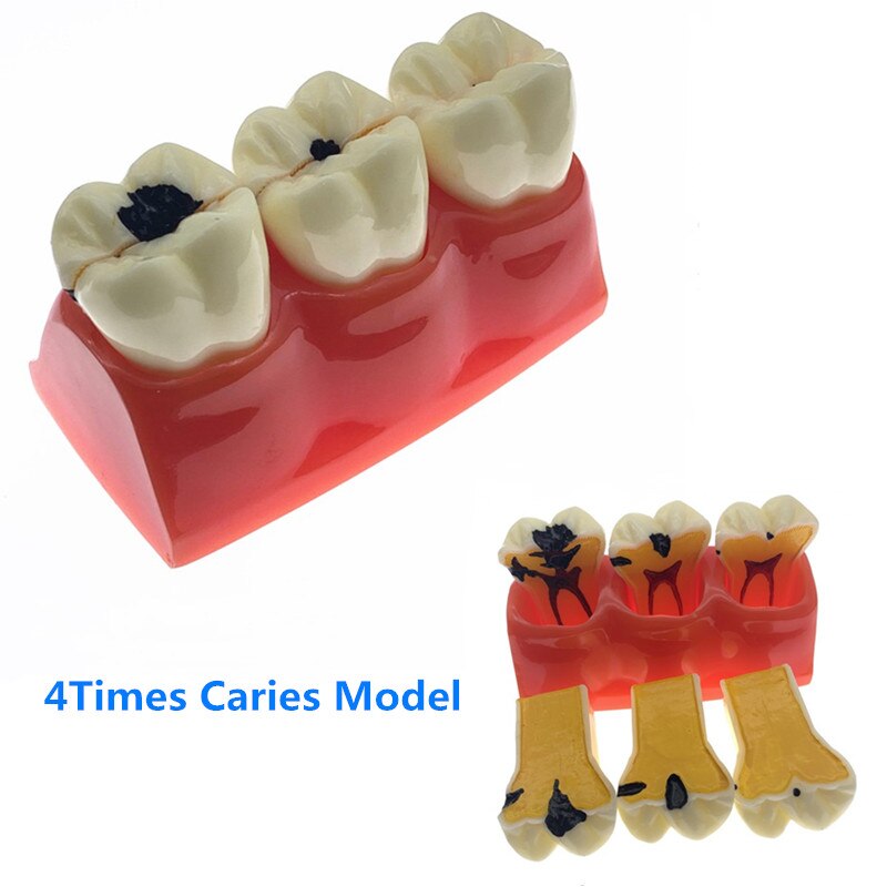 4times Caries Models Caries Teeth Model For Showin Vicedeal