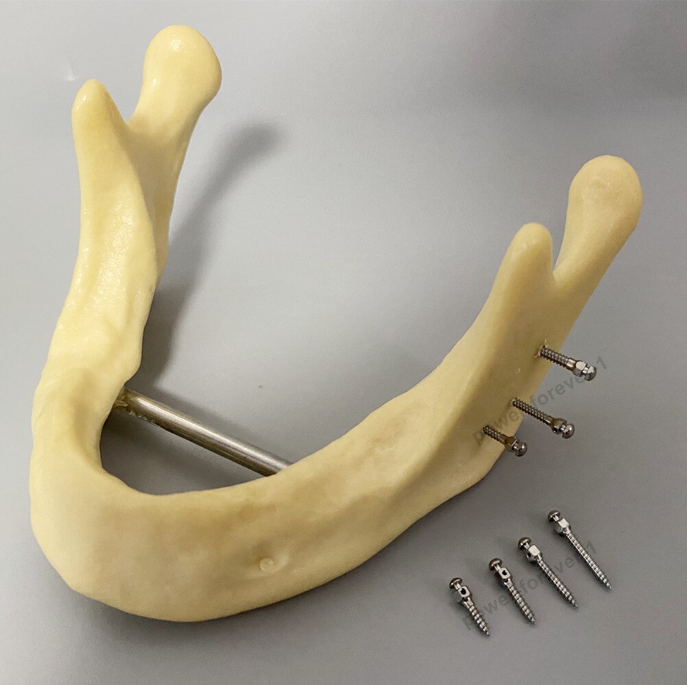 10Pis/Lot Orthodontic Screws Micro Implants Mini S... – Grandado