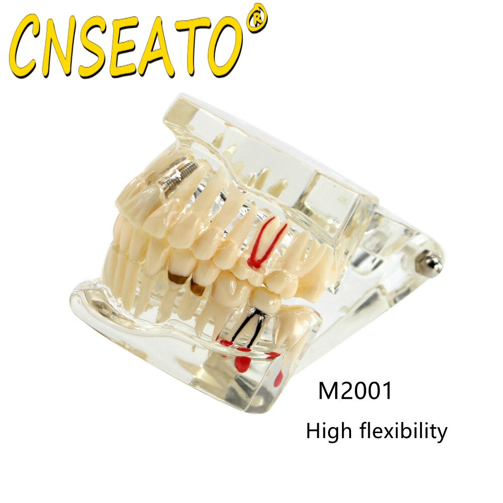 1 PC Dental Implant Restoration Model Teeth Bridge... – Grandado