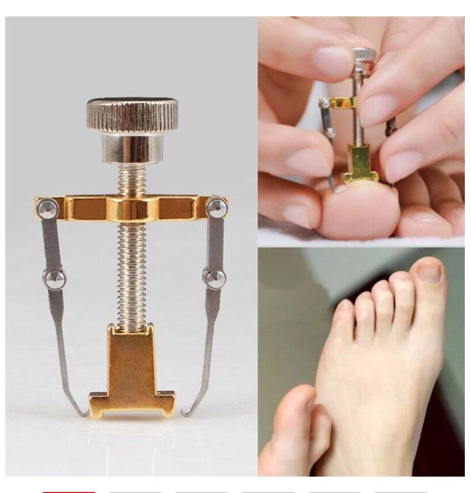 Ingrown Nail Remover Toe Ingrown Toenail Trimmer C... – Grandado