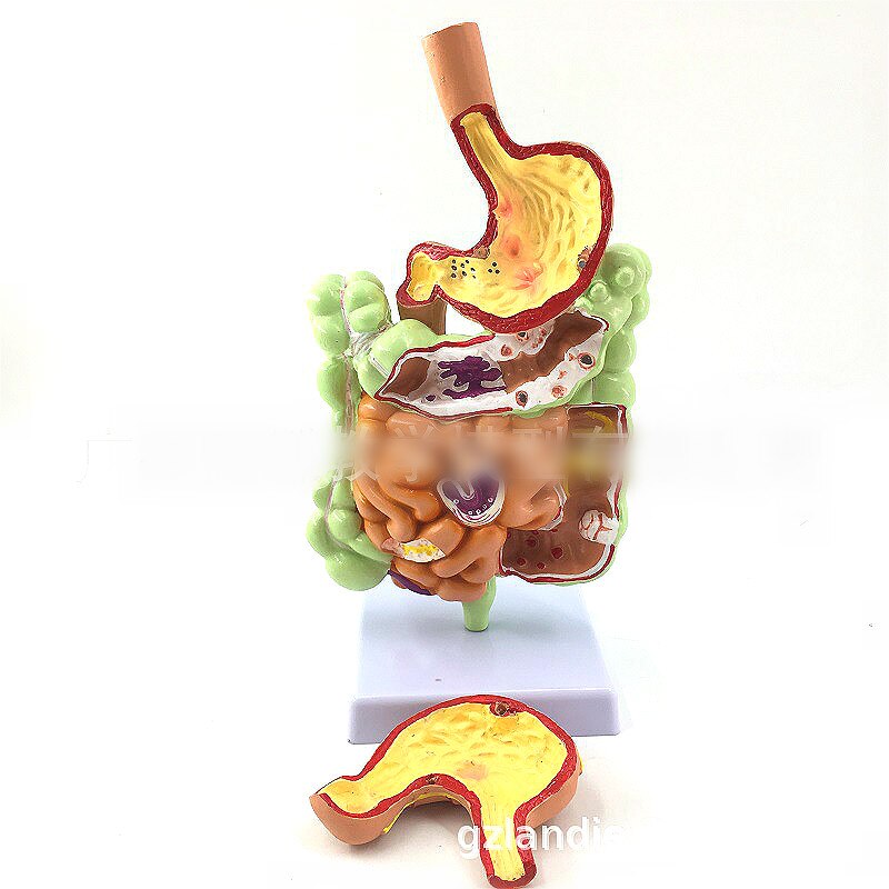 Pathological model of large intestine stomach mode... – Vicedeal