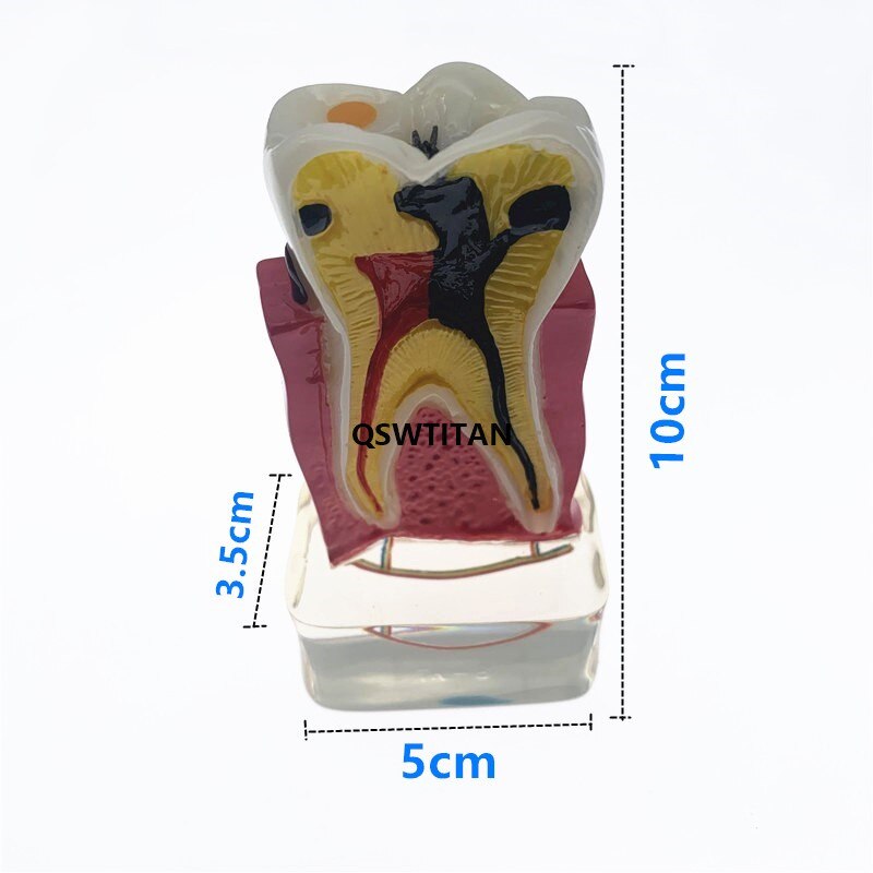Teeth Model 4 times tooth pathology model Comprehe... – Grandado