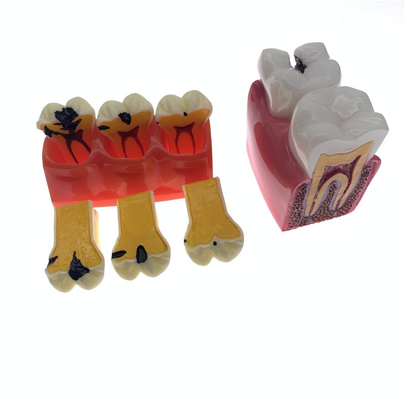 Dental Teeth Model Caries Comparation Study Models... – Vicedeal