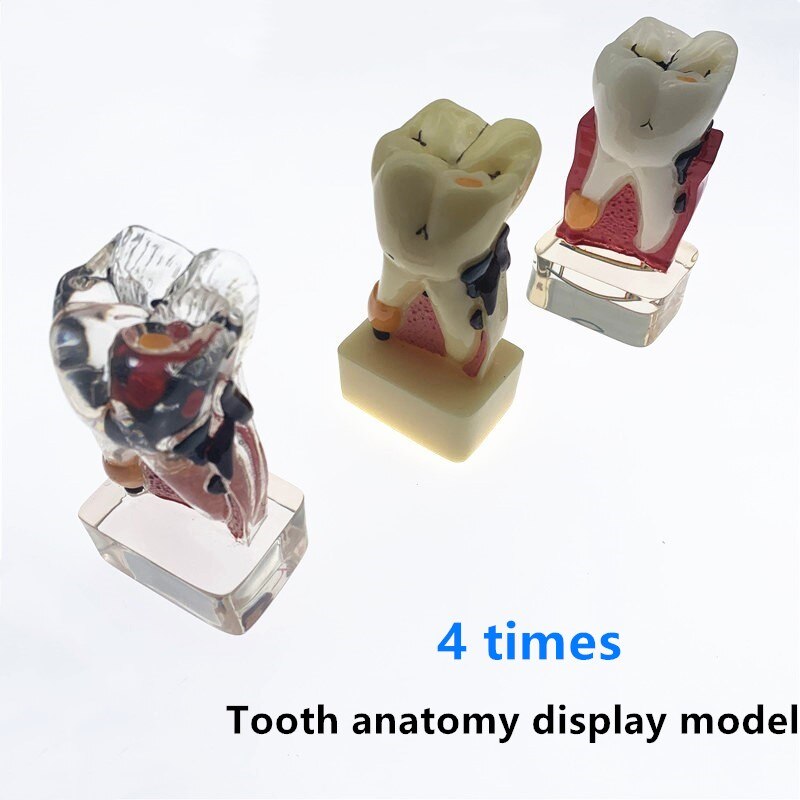 Teeth Model 4 times tooth pathology model Comprehe... – Vicedeal
