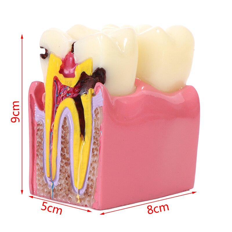 Dental Teeth Model 6 Times Caries Comparation Stud... – Vicedeal
