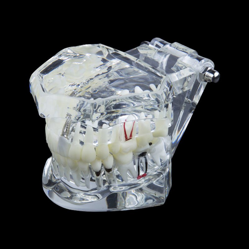 Dentist tooth human anatomy model classic repairab... – Grandado
