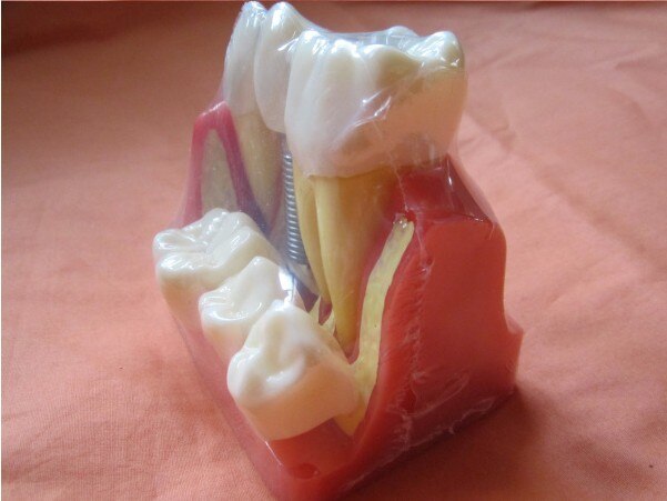 Dental teeth model dental planting teeth model dec... – Grandado