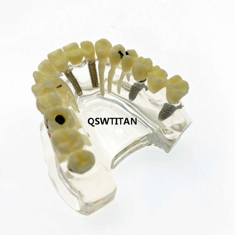 Dental Implant Upper Jaw Model With Bridge & C... – Grandado
