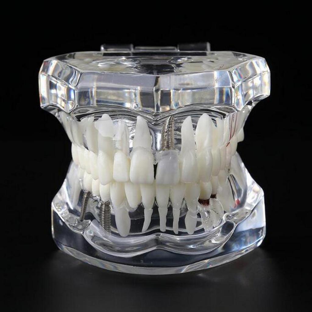 1pc Transparent Study Teeth Model with Nerve Repai... – Grandado