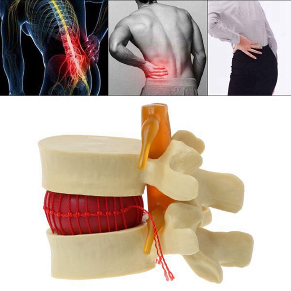 Lumbar Vertebrae Model Anatomical Spine Lumbar Dis... – Vicedeal