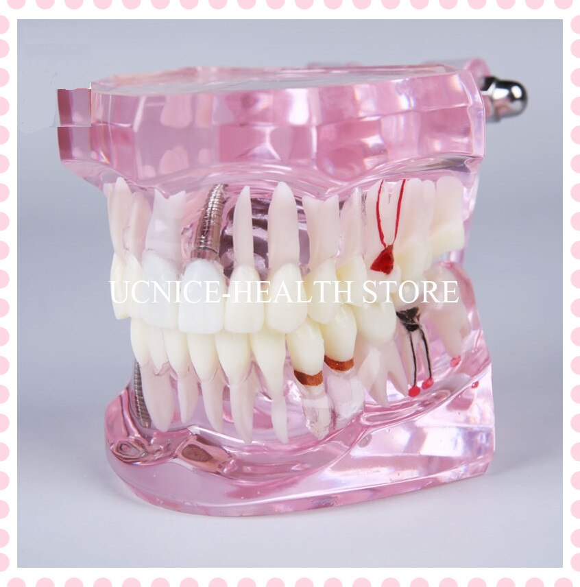 Dental Study Tooth Implant Pathological Teeth mode... – Grandado