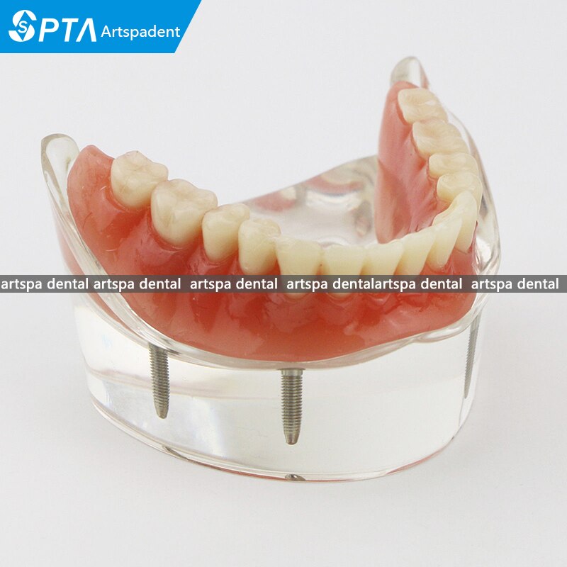 Dental Teeth Study Model Overdenture Inferior 4 Im... – Grandado