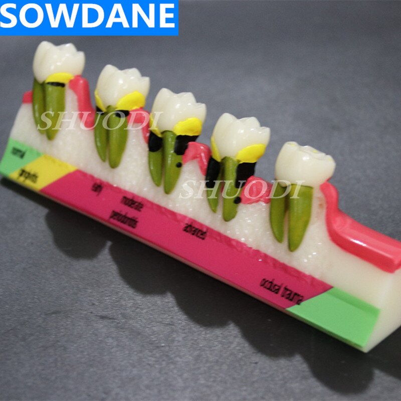 Dental Teeth Model Periodontal Disease Assort Toot... – Grandado