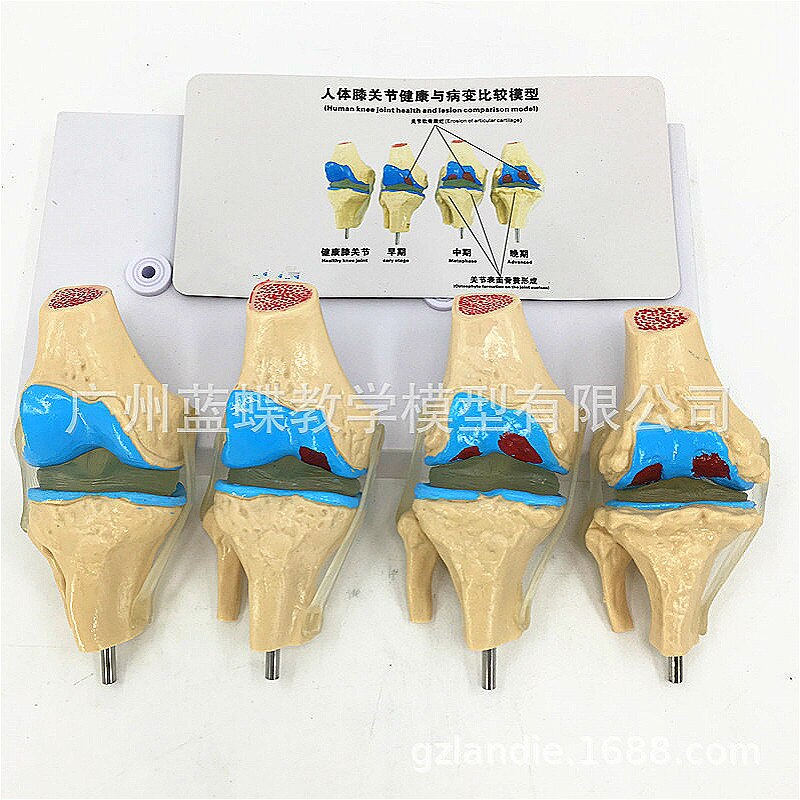 4 pcs Human pathological knee joint model Degenera... – Grandado