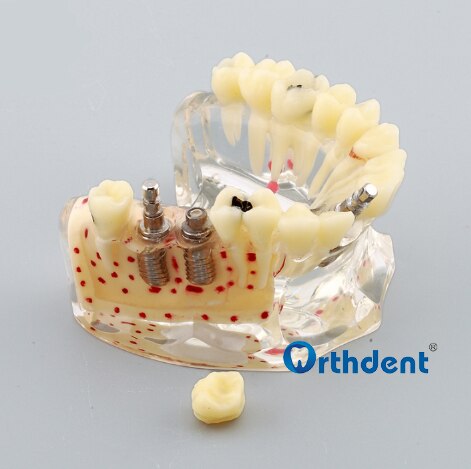 Dental Implant Teeth Model Demo Overdenture Restor... – Grandado